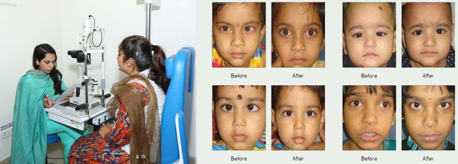 Squint Services – Ambaye Eye Care